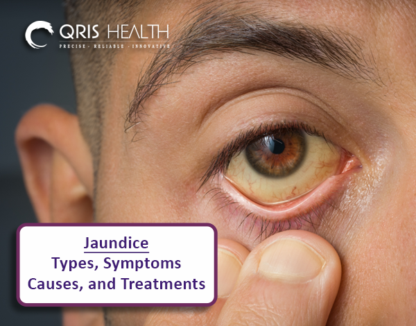 Jaundice: Types, Symptoms, Causes, and Treatments | Qris Health